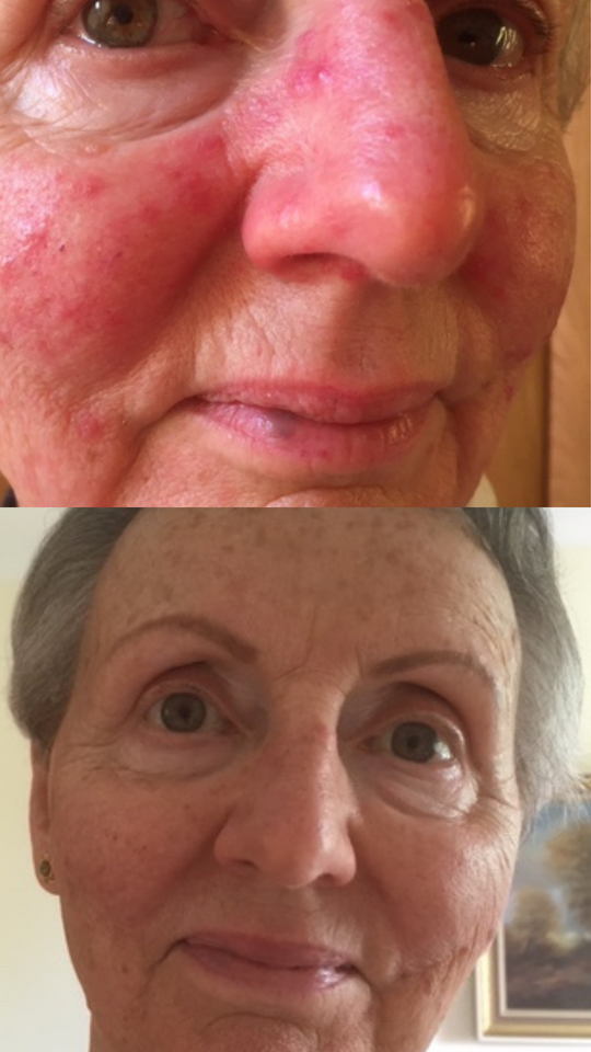 Redness Reducing Rosacea Cream | Dermatology M – Dermatology M Store