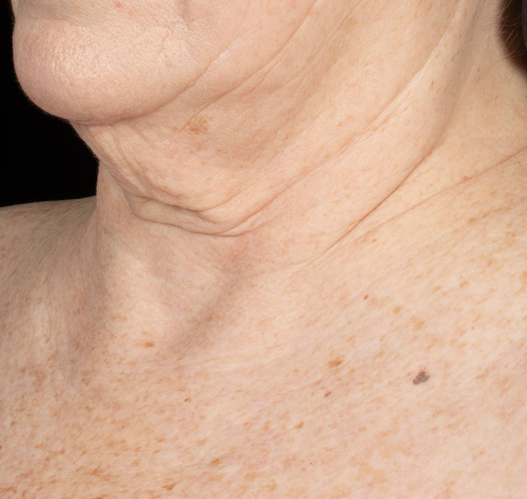 Neck & Decollete Firming Concentrate for Aging Skin | Obagi Medical