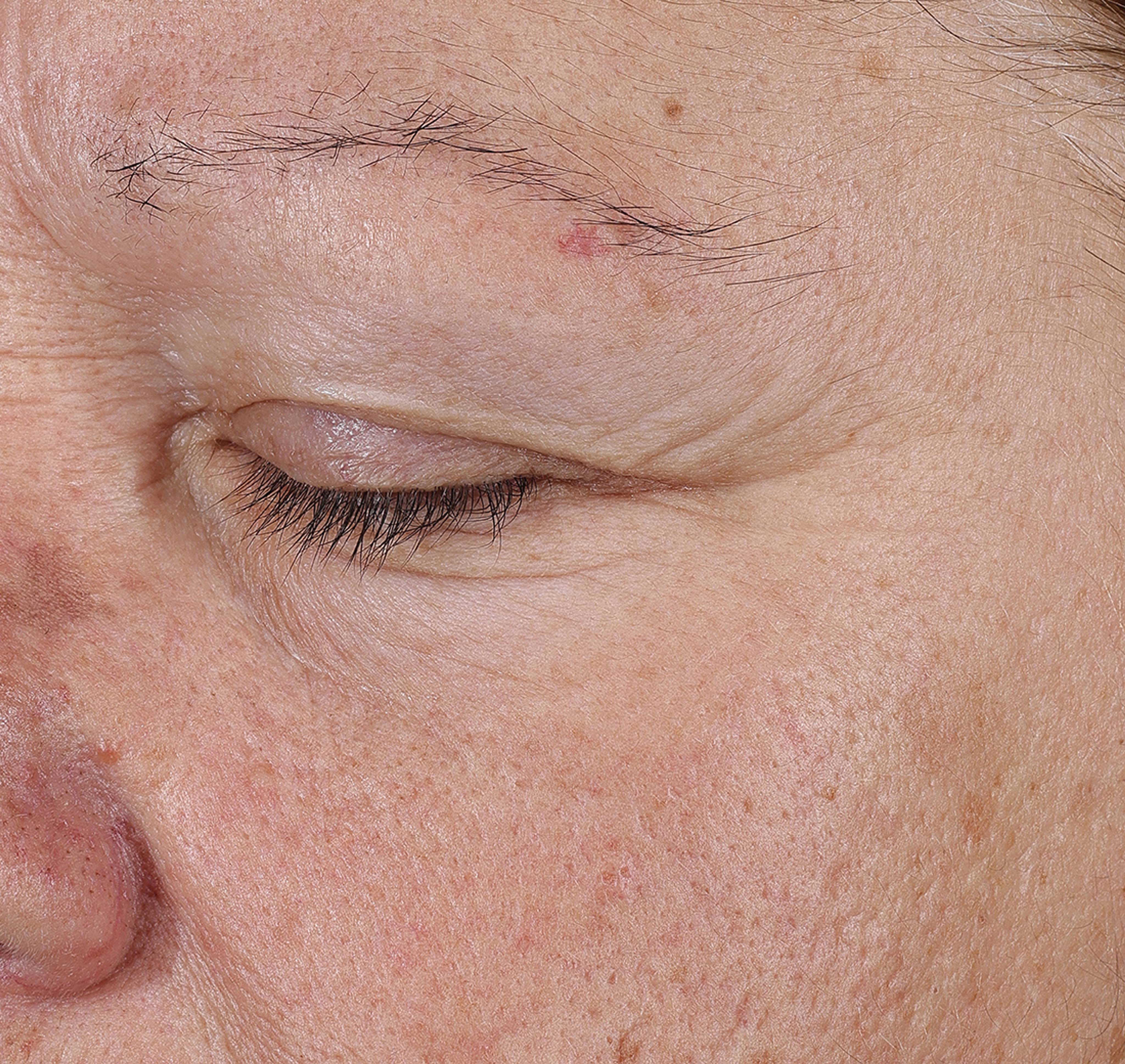 ELASTIDERM® Advanced Filler Concentrate for Fine Lines & Wrinkles | Obagi