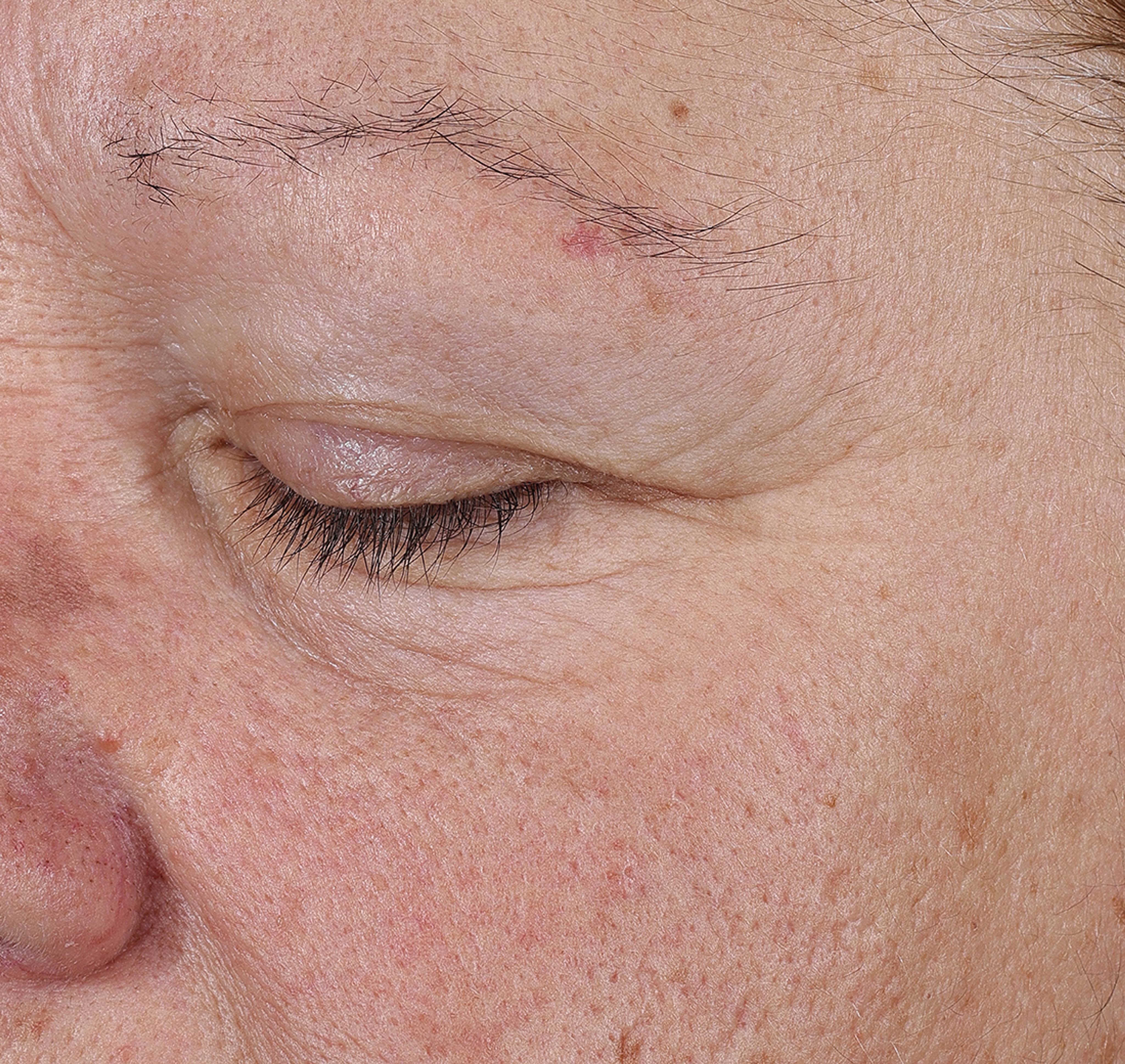 ELASTIDERM® Advanced Filler Concentrate for Fine Lines & Wrinkles | Obagi