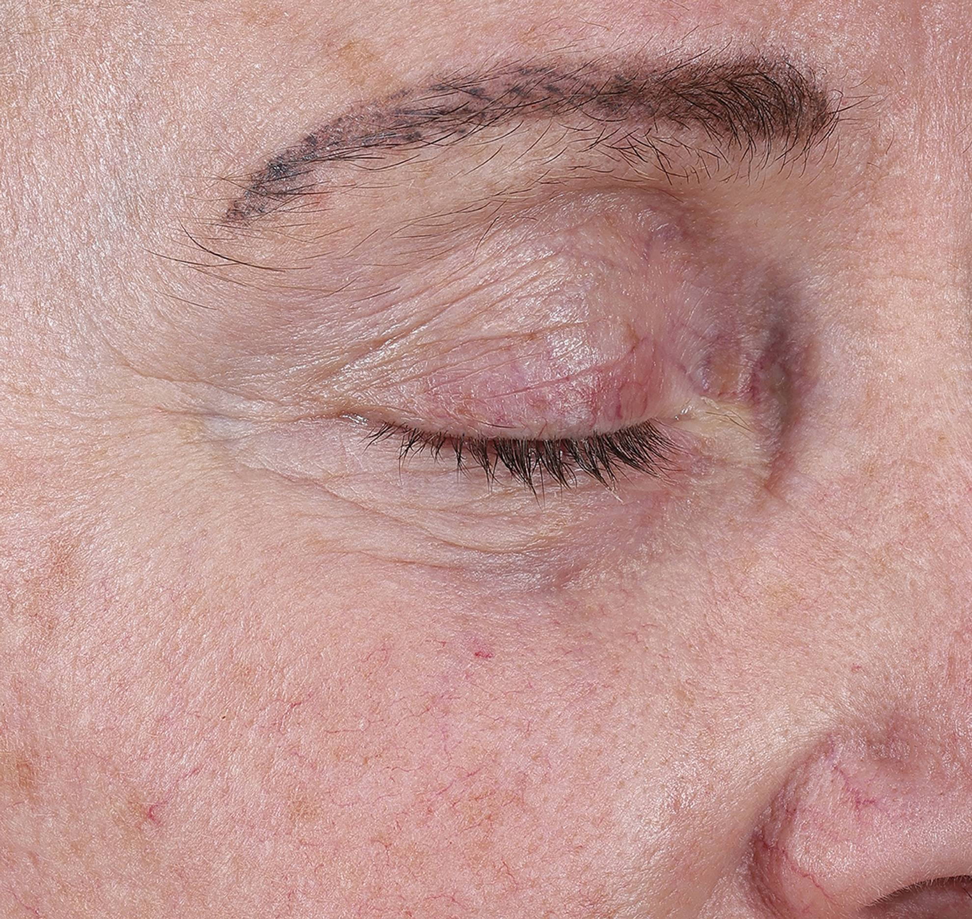 ELASTIDERM® Advanced Filler Concentrate for Fine Lines & Wrinkles | Obagi