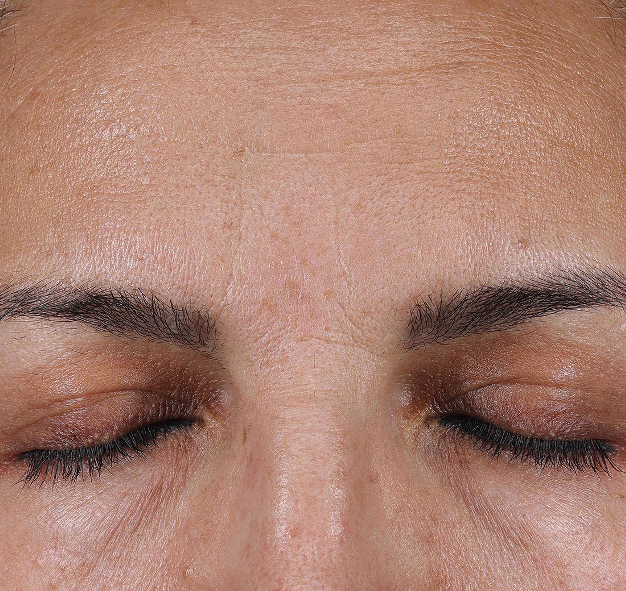 ELASTIDERM® Advanced Filler Concentrate for Fine Lines & Wrinkles | Obagi